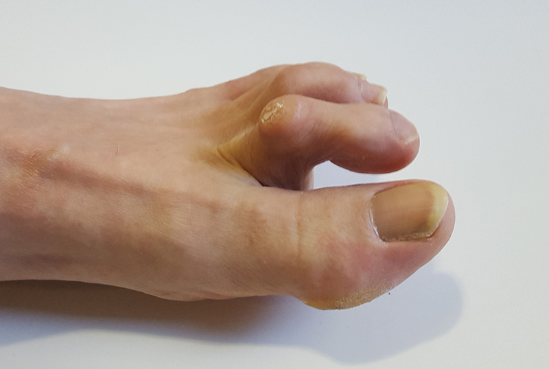 Flexion Contracture Deformities